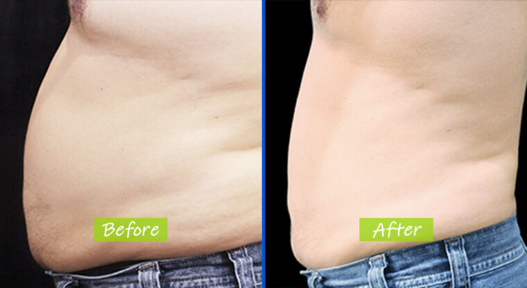 Vanquish Me - FitShop's Fat Reduction Treatment Albuquerque