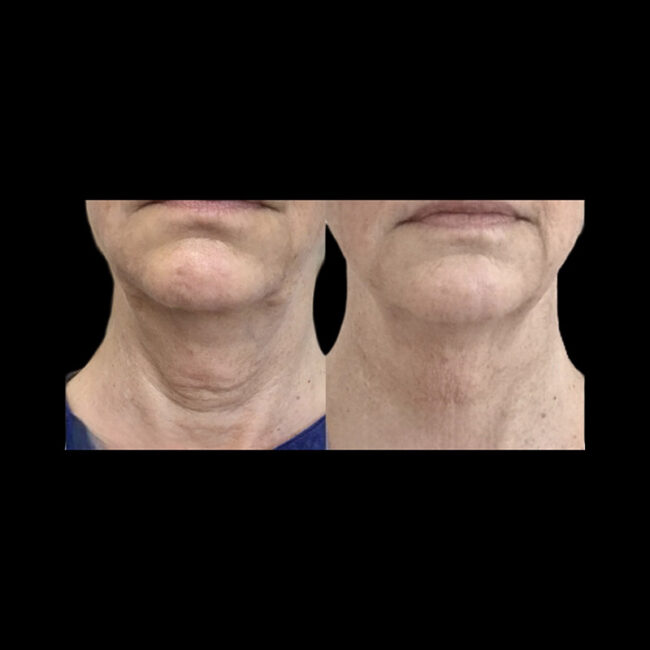 SCARLET SRF - A Groundbreaking Minimally Invasive RF Microneedling Device
