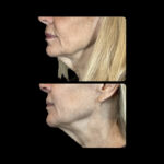SCARLET SRF - A Groundbreaking Minimally Invasive RF Microneedling Device